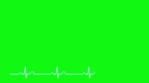 Motion Graphic of Normal EKG Waveform on... | Stock Video | Pond5
