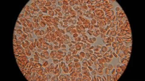 Haemoglobin Stock Video Footage | Royalty Free Haemoglobin Videos | Pond5