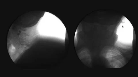 Spine X Ray Stock Video Footage | Royalty Free Spine X Ray Videos | Pond5