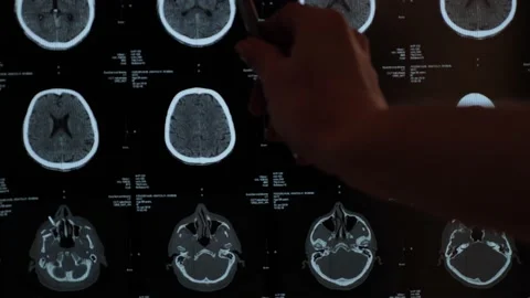 MRI of the brain of an old man | Stock Video | Pond5