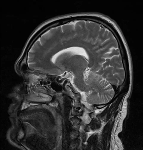 MRI brain scan animation on a black back... | Stock Video | Pond5