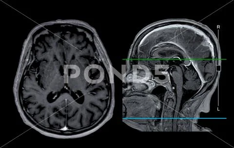 MRI brain scan Axial and sagittal view with reference line for detect ...