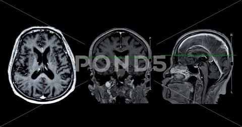 MRI brain scan Axial , Coronal and sagittal view with referance line ...