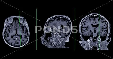 MRI brain scan Axial , Coronal and sagittal view with referance line ...