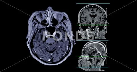 MRI brain scan Axial , Coronal and sagittal view with referance line ...