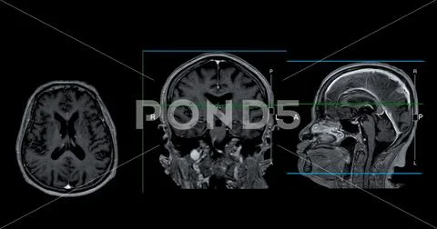 MRI brain scan Axial , Coronal and sagittal view with referance line ...