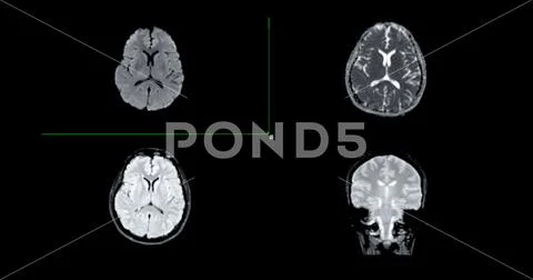 MRI brain scan axial Diffusion technique and coronal gredient for ...