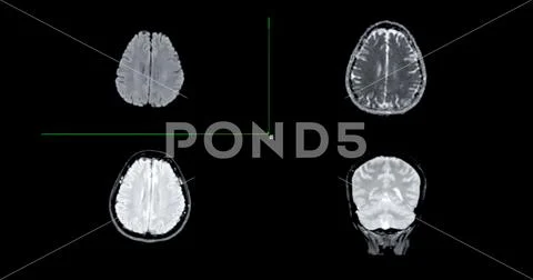 MRI brain scan axial Diffusion technique and coronal gredient for ...