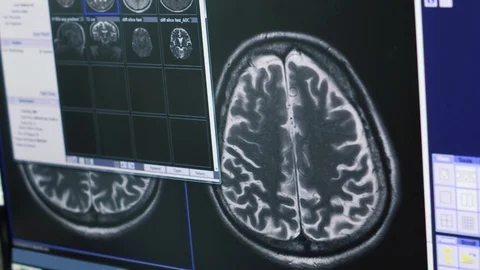 MRI brain scan, computer monitor | Stock Video | Pond5