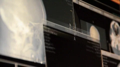 MRI Brain Scan Computer Screen Output | Stock Video | Pond5