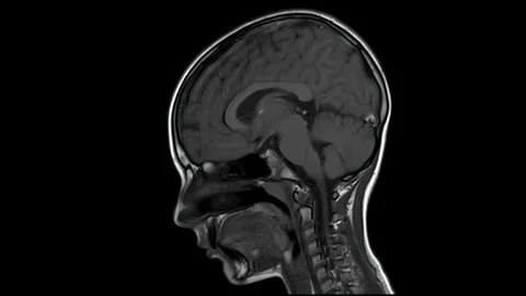MRI brain scan of a healthy 10 year old ... | Stock Video | Pond5
