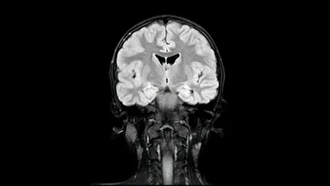 MRI brain scan of a healthy 10 year old ... | Stock Video | Pond5