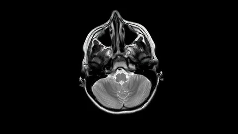 MRI brain scan of a healthy 10 year old ... | Stock Video | Pond5