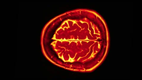 Mri Brain Scan. Human Brain Scan. | Stock Video | Pond5