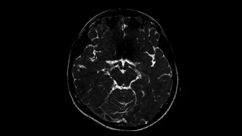 MRI Brain Scan of Human: High-Resolution... | Stock Video | Pond5