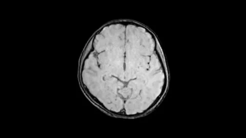 MRI Brain Scan of Human: High-Resolution... | Stock Video | Pond5