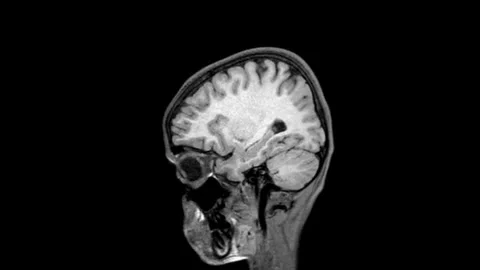 MRI Brain Scan of Human: High-Resolution... | Stock Video | Pond5
