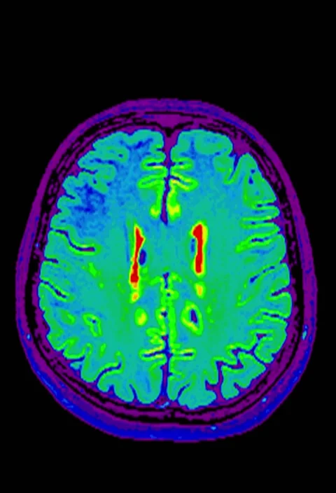 Mri Brain Scan, Magnetic Resonance Imagi... | Stock Video | Pond5