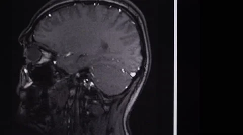 MRI brain scan, side view, top view | Stock Video | Pond5