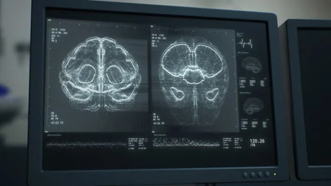 MRI brain scanning displayed on hospital... | Stock Video | Pond5