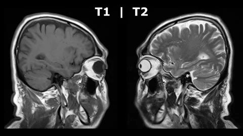MRI brain scans, comparing T1- and T2-we... | Stock Video | Pond5