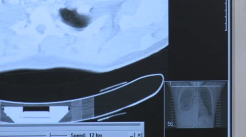 MRI CT Scan Chest on Monitor | Stock Video | Pond5