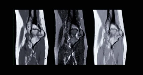 MRI elbow joint . | Stock Video | Pond5