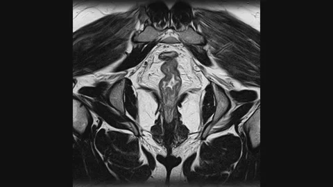 MRI of the female pelvic organs, abdomin... | Stock Video | Pond5