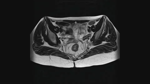 MRI of the female pelvic organs, abdomin... | Stock Video | Pond5