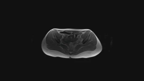 MRI of the female pelvic organs, abdomin... | Stock Video | Pond5