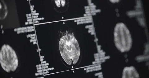 MRI Head Scans Angled Close Up Pan Right | Stock Video | Pond5