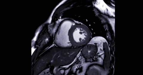 MRI heart or Cardiac MRI ( magnetic reso... | Stock Video | Pond5