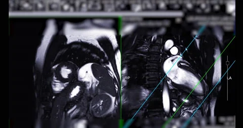 MRI heart or Cardiac MRI ( magnetic reso... | Stock Video | Pond5