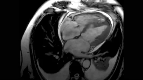 MRI heart or Cardiac MRI or magnetic res... | Stock Video | Pond5