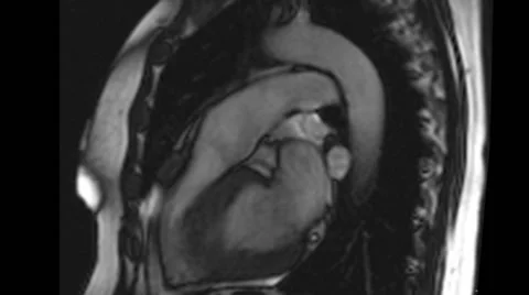 MRI of the Heart, Sagittal or Left Side ... | Stock Video | Pond5