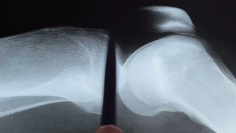 MRI of knee injury. Tumor, rupture of li... | Stock Video | Pond5