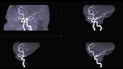 MRI MRA brain 3D mip for detect Brain st... | Stock Video | Pond5