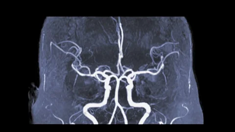MRI MRA brain 3D mip for detect Brain St... | Stock Video | Pond5