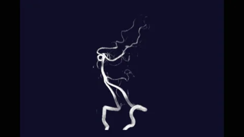 MRI MRA brain 3D mip of basilar artery ... | Stock Video | Pond5