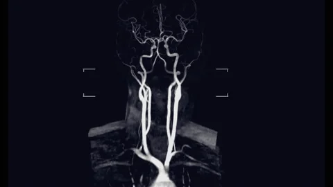 MRI MRA brain3D MIP for detect Brain dis... | Stock Video | Pond5