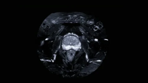 MRI prostate gland axial T2 fat suppress... | Stock Video | Pond5