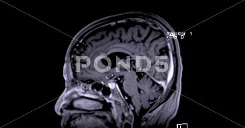 MRI scan of the brain for detect Brain diseases sush as stroke disease ...