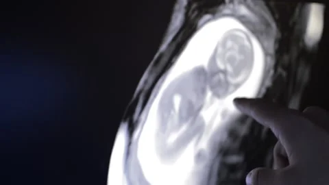 mri scan of a fetus on the mother belly.... | Stock Video | Pond5