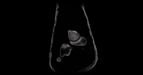MRI scan of a foot showing multiple smal... | Stock Video | Pond5