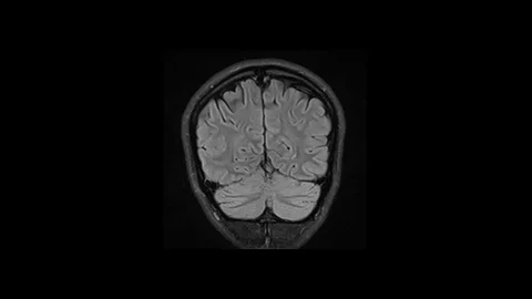 Mri Scan. Human Brain. RMN Scan. | Stock Video | Pond5