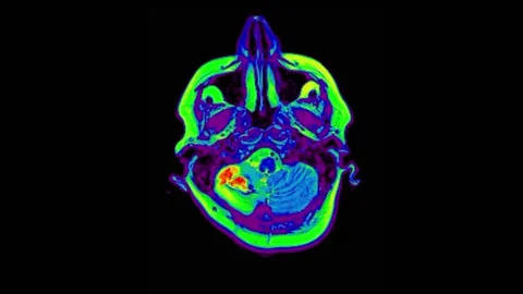 Mri Scan. Human Brain. RMN Scan. | Stock Video | Pond5