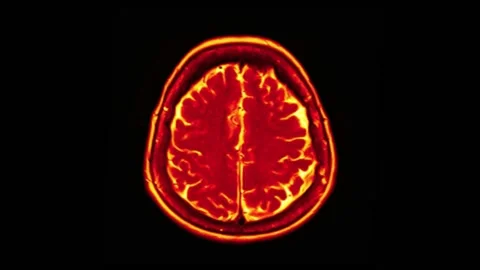 Mri Scan. Human Brain. RMN Scan. | Stock Video | Pond5
