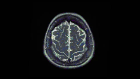 Mri Scan. Human Brain. RMN Scan. | Stock Video | Pond5