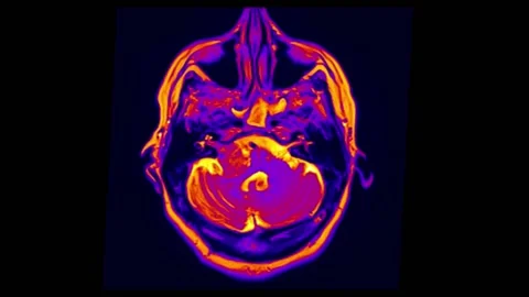 Mri Scan. Human Brain. RMN Scan. | Stock Video | Pond5
