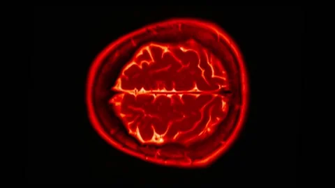 Mri Scan. Human Brain. RMN Scan. | Stock Video | Pond5